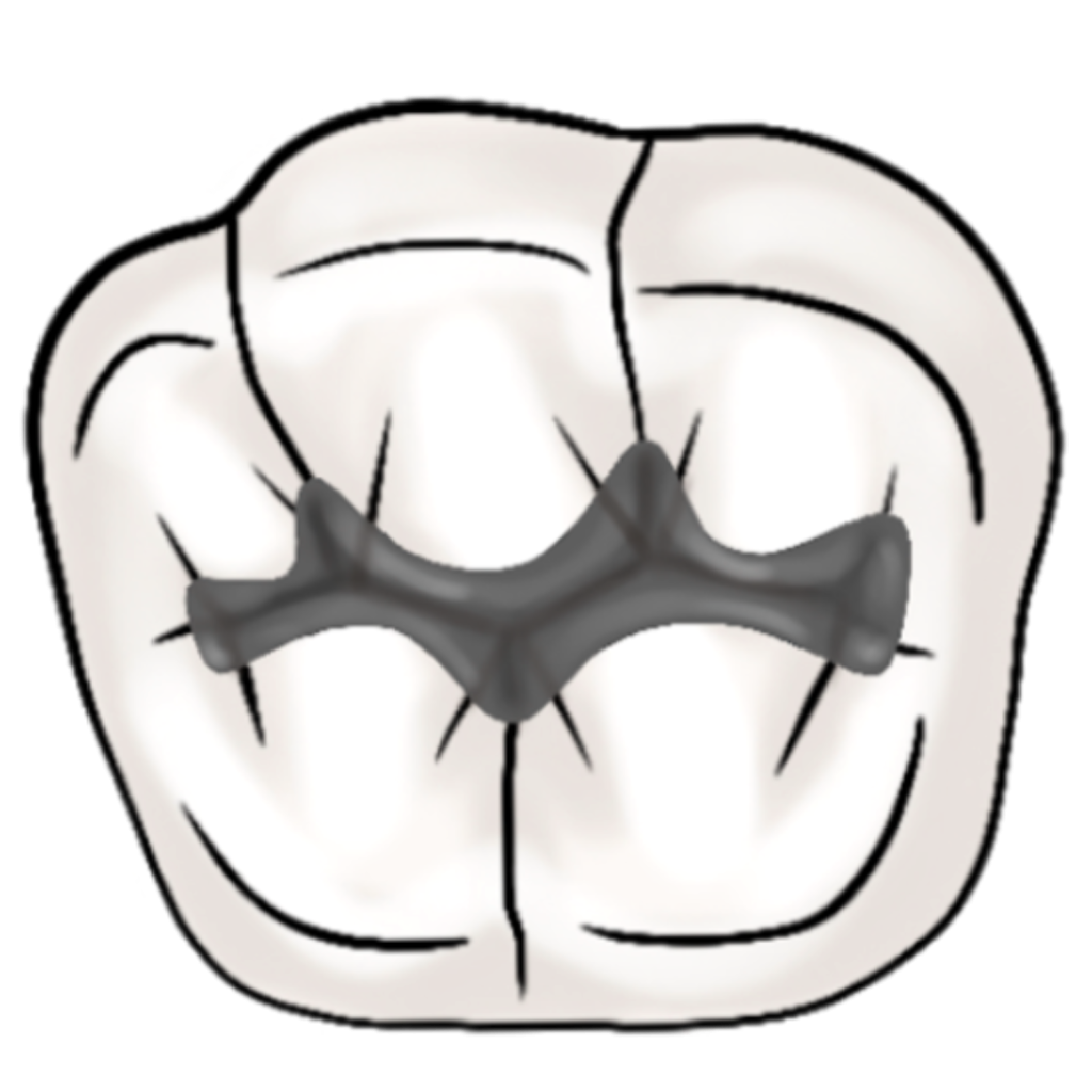 Amalgam - My Dental Key