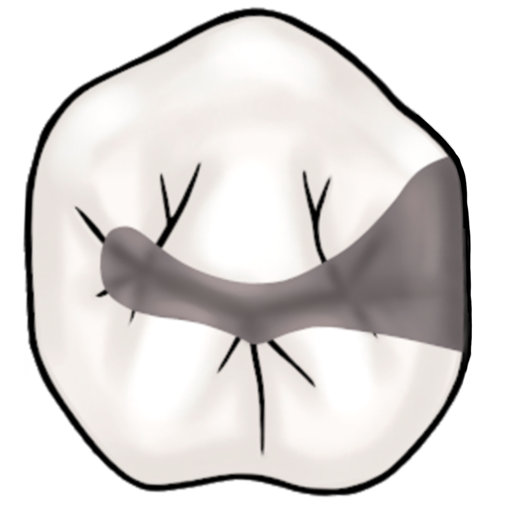 Amalgam - My Dental Key