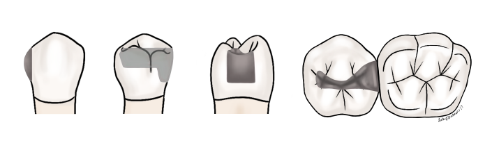 Class II Amalgam Restoration - My Dental Key