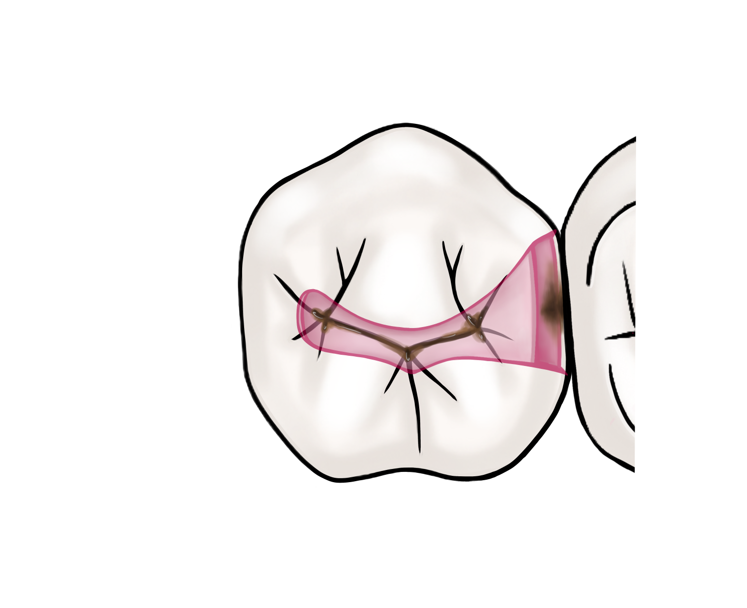 Class II Amalgam Preparation - My Dental Key