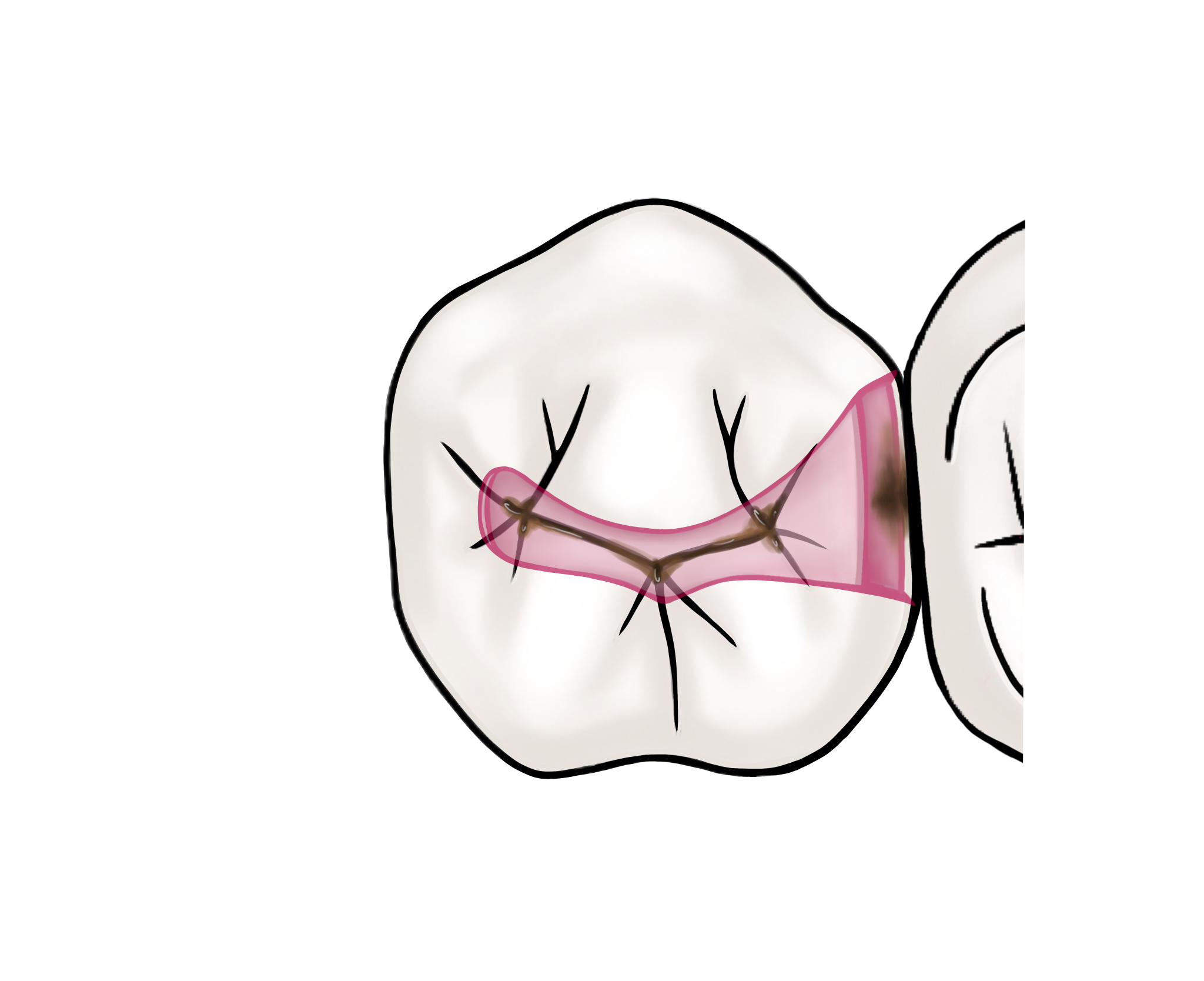 Class II Amalgam Preparation - My Dental Key