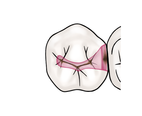 Class II Amalgam Preparation - My Dental Key