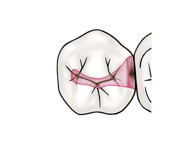 Class II Amalgam Preparation - My Dental Key