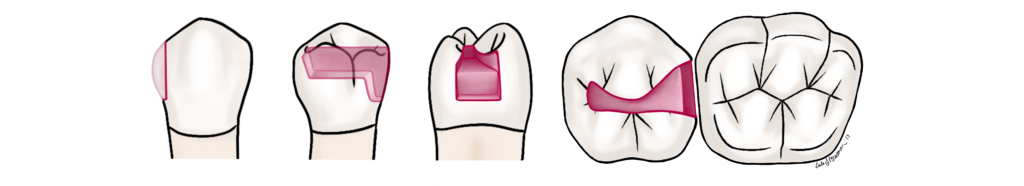 Class II Amalgam Preparation - My Dental Key