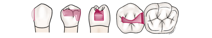 Class II Amalgam Preparation - My Dental Key