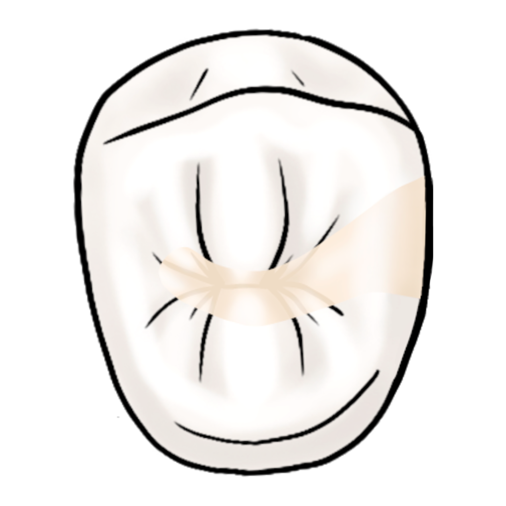 Resin Composite Operative Dentistry My Dental Key