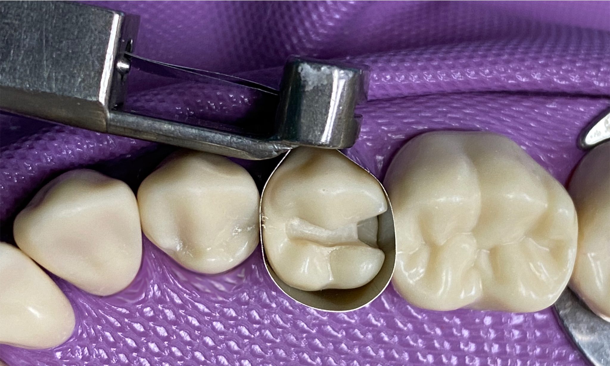 Class II Amalgam Restoration - My Dental Key