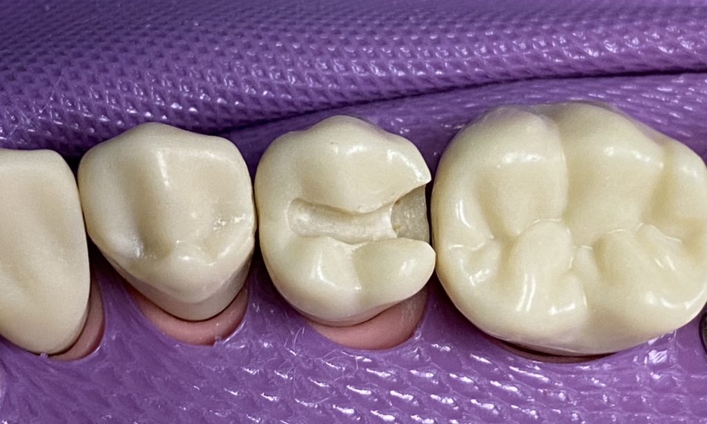 Class II Amalgam Restoration - My Dental Key