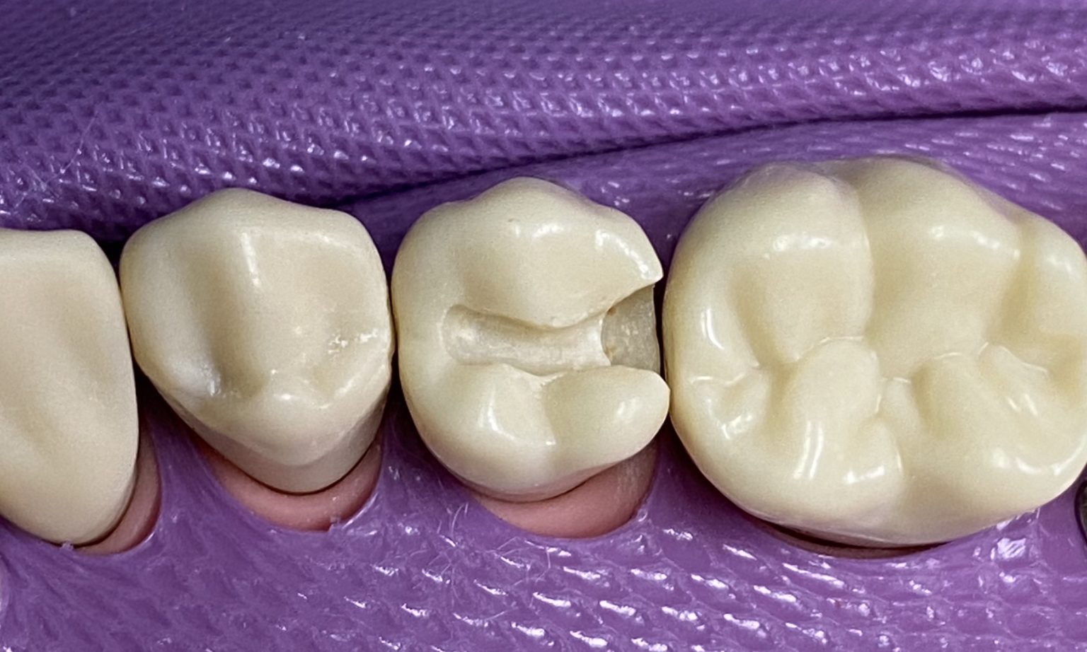 Class II Amalgam Restoration - My Dental Key