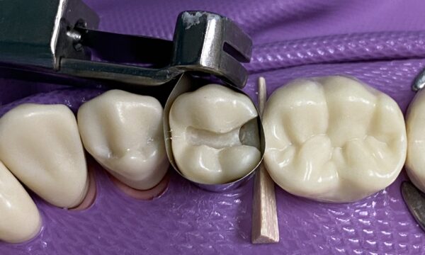 Class II Amalgam Restoration - My Dental Key