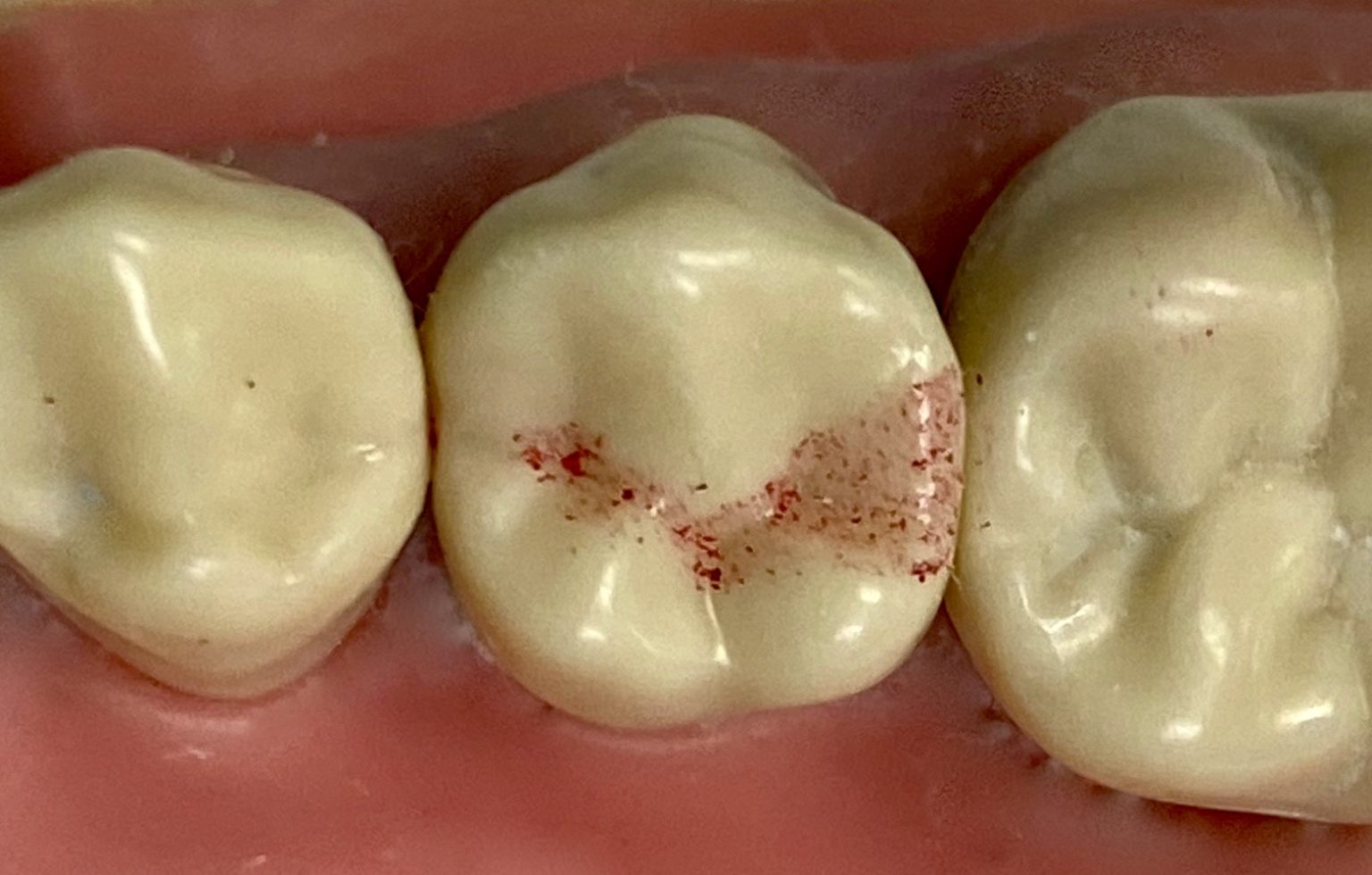 Class II Amalgam Preparation - My Dental Key