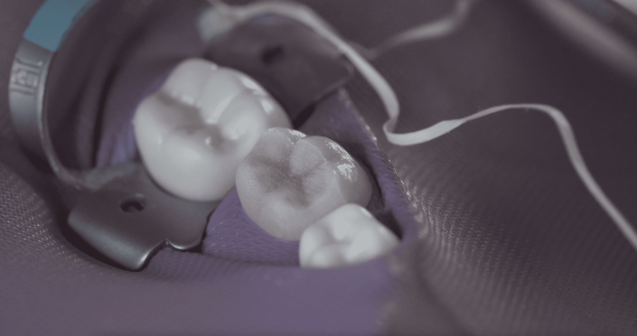 Stainless Steel Crown Preparation - My Dental Key