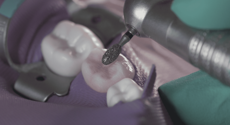 Stainless Steel Crown Preparation - My Dental Key