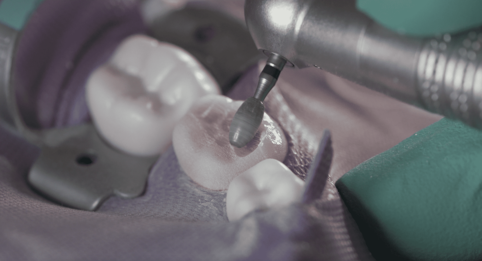 Stainless Steel Crown Preparation - My Dental Key