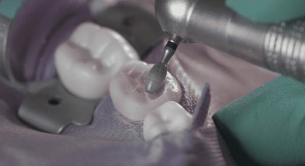 Stainless Steel Crown Preparation - My Dental Key