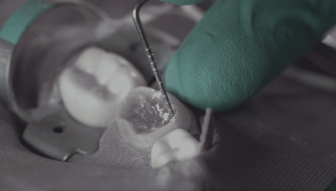 Stainless Steel Crown Preparation - My Dental Key