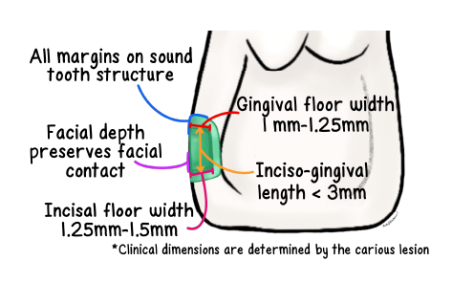 Class III Composite Preparation - My Dental Key