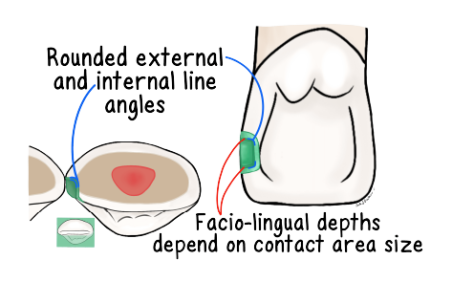 Class III Composite Preparation - My Dental Key