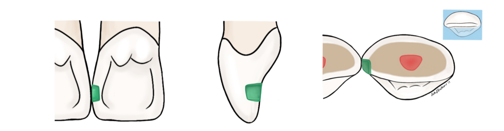 Class III Composite Preparation - My Dental Key