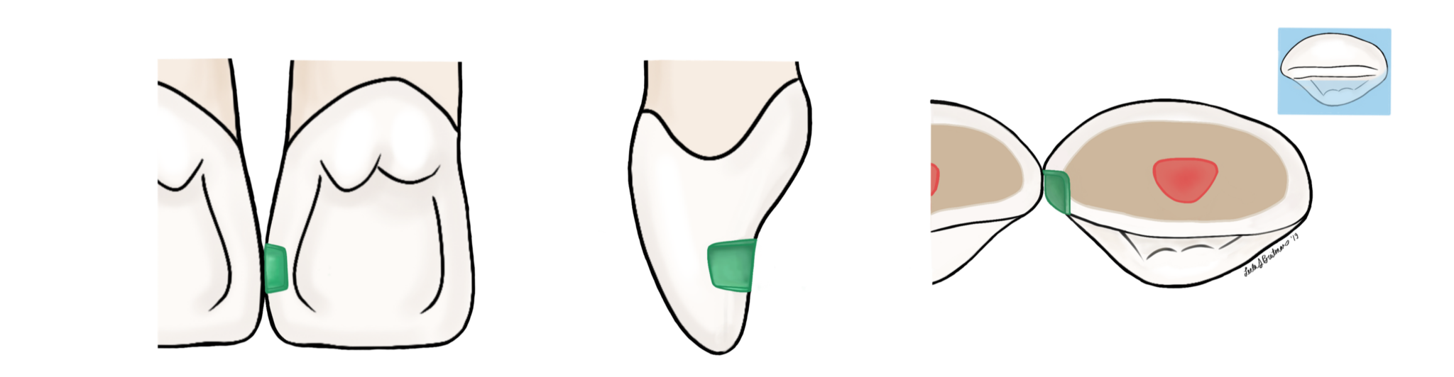 Class III Composite Preparation - My Dental Key