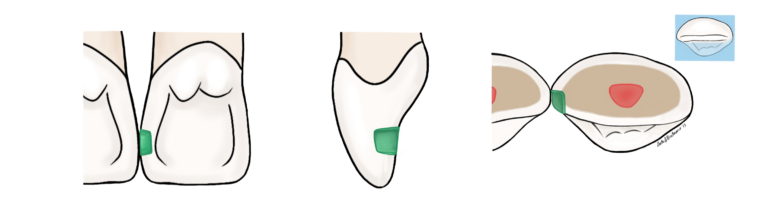 Class III Composite Preparation - My Dental Key