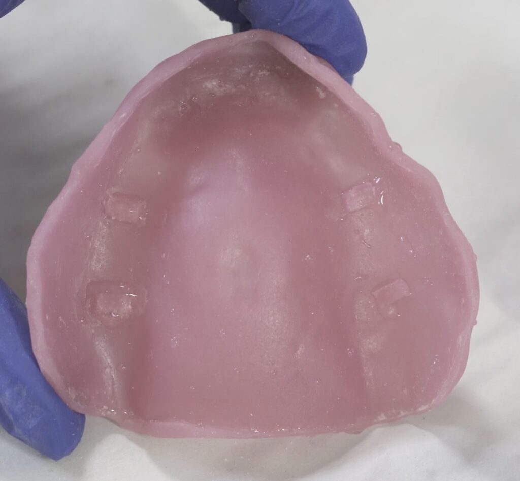 Maxillary Final Impressions - My Dental Key