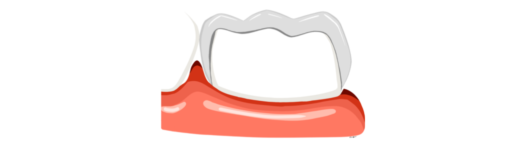 Stainless Steel Crown Preparation - My Dental Key