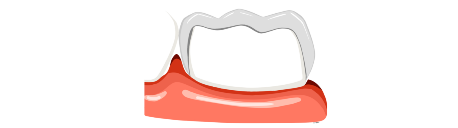 Stainless Steel Crown Preparation - My Dental Key
