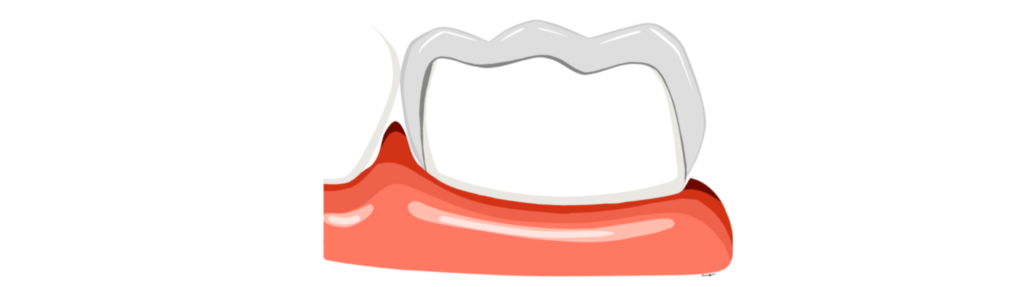 Stainless Steel Crown Preparation - My Dental Key