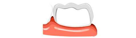 Stainless Steel Crown Preparation - My Dental Key
