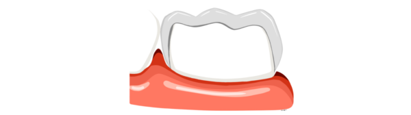 Stainless Steel Crown Preparation - My Dental Key