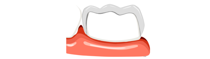 Stainless Steel Crown Preparation - My Dental Key