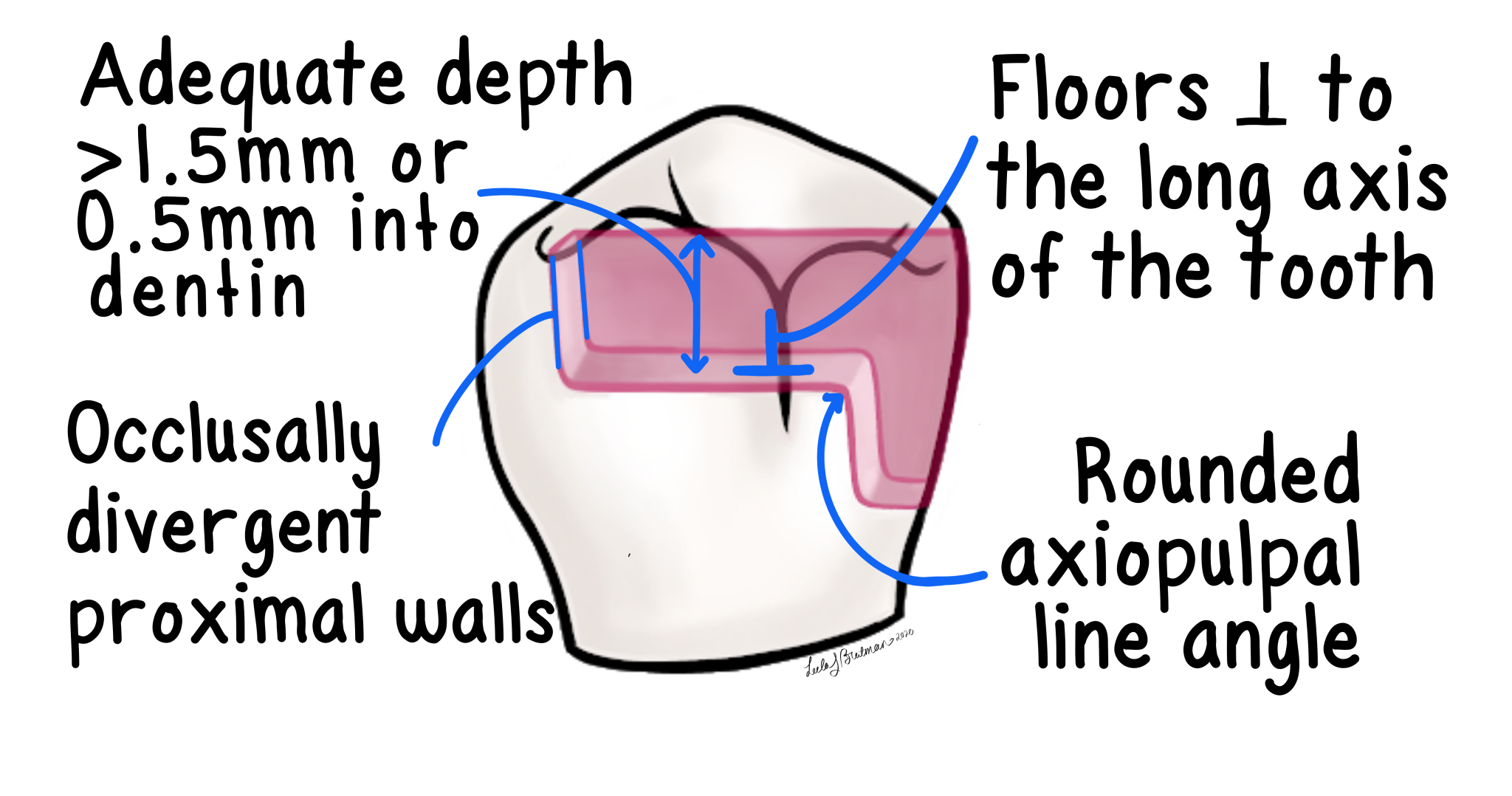Class II Amalgam Preparation - My Dental Key