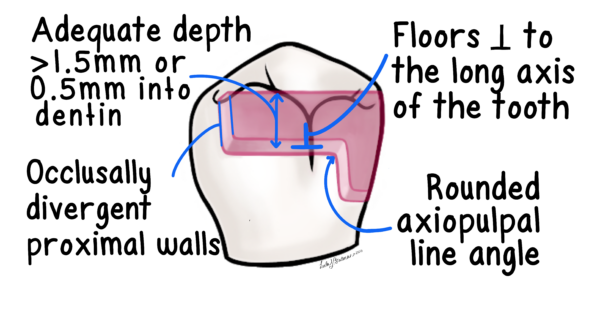 Class II Amalgam Preparation - My Dental Key