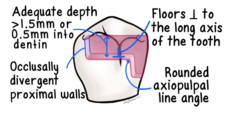 Class II Amalgam Preparation - My Dental Key