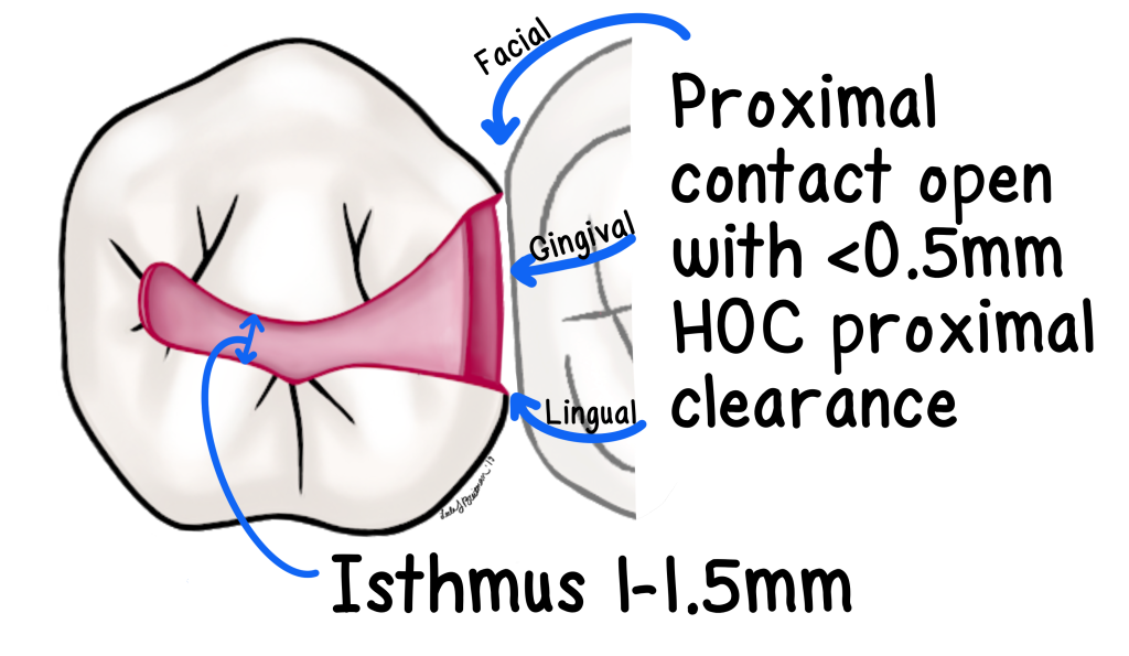 Class II Amalgam Preparation - My Dental Key