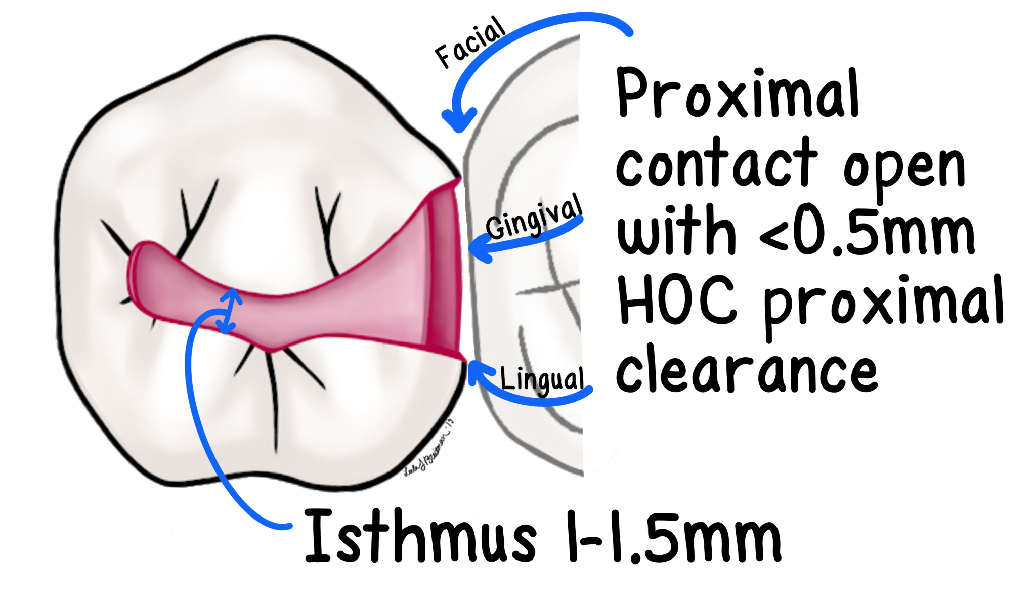 Class II Amalgam Preparation - My Dental Key