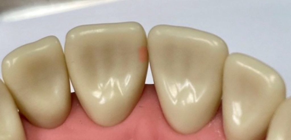 Class III Composite Preparation - My Dental Key