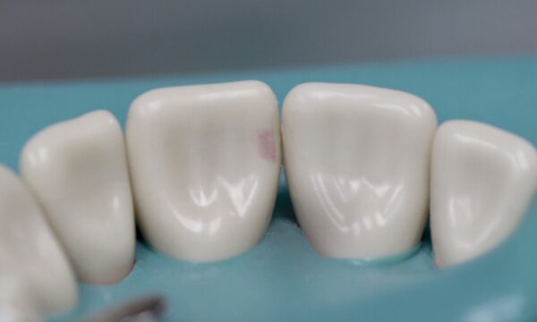 Class III Composite Preparation - My Dental Key
