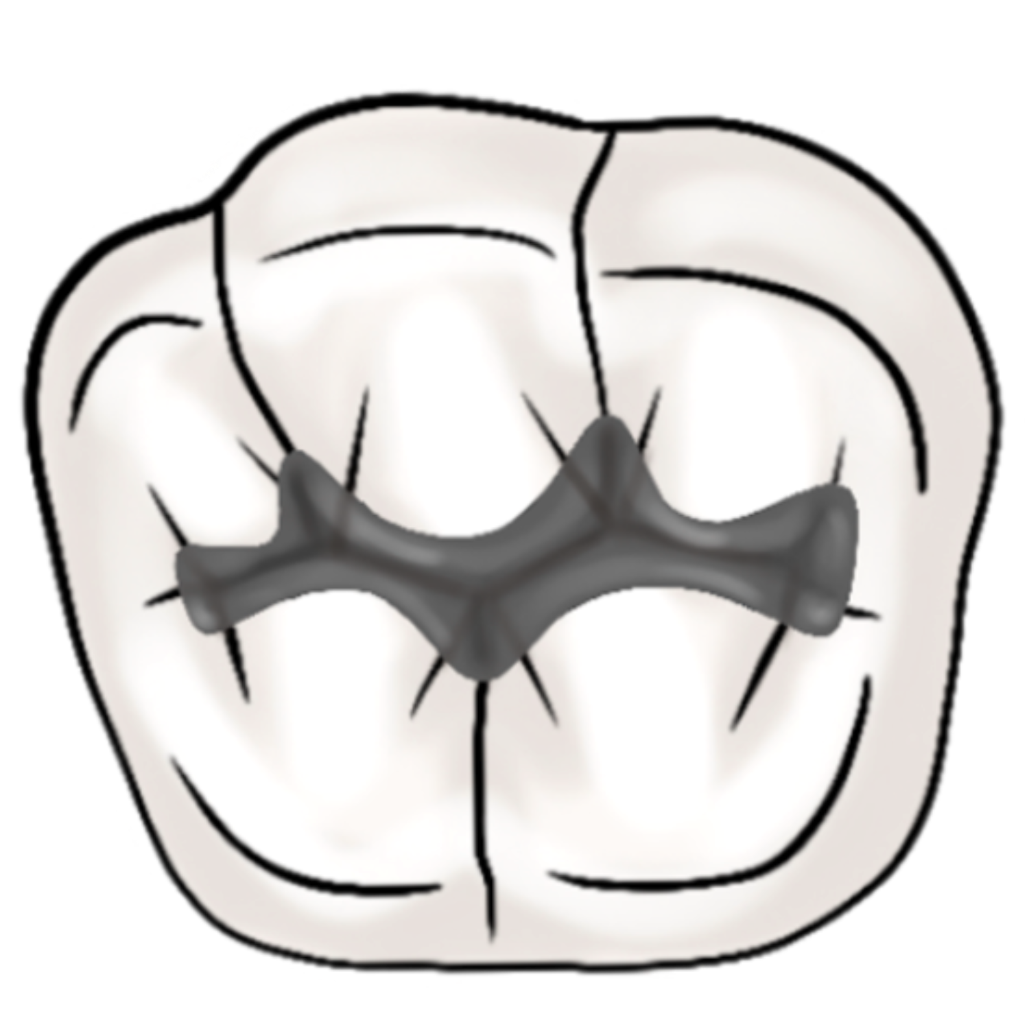 Amalgam - My Dental Key