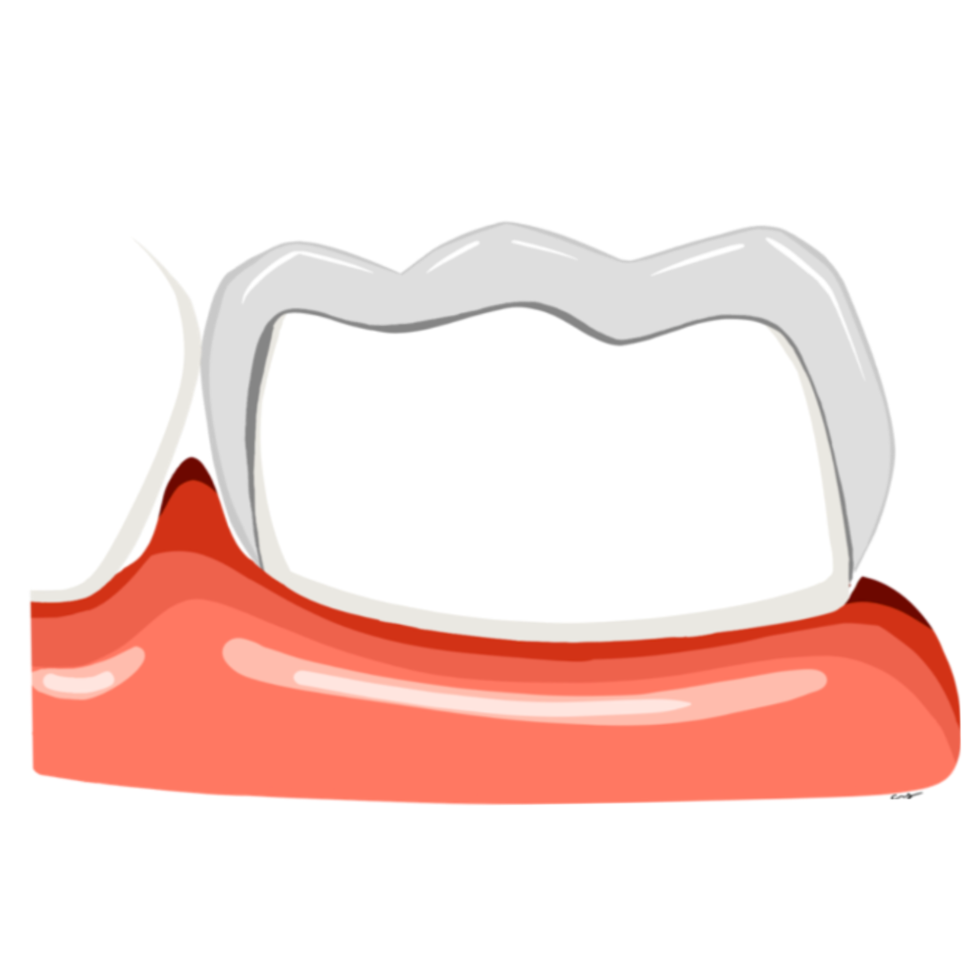 Stainless Steel Crown Preparation - My Dental Key
