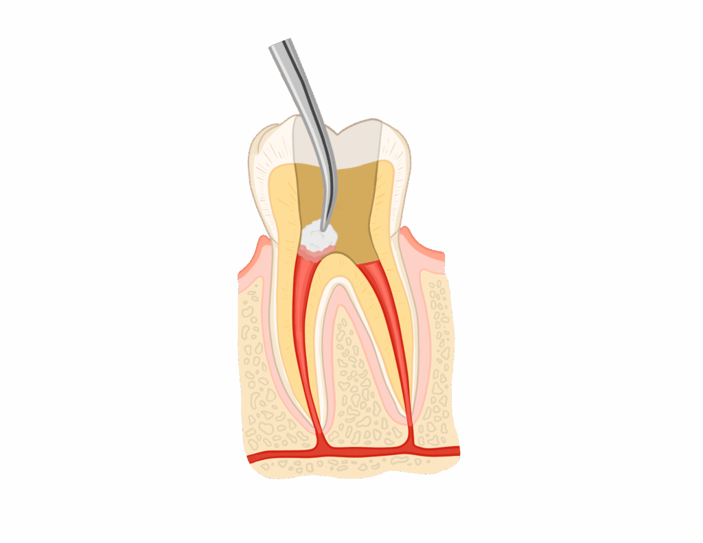 Pulpotomy vs. Pulpectomy - My Dental Key
