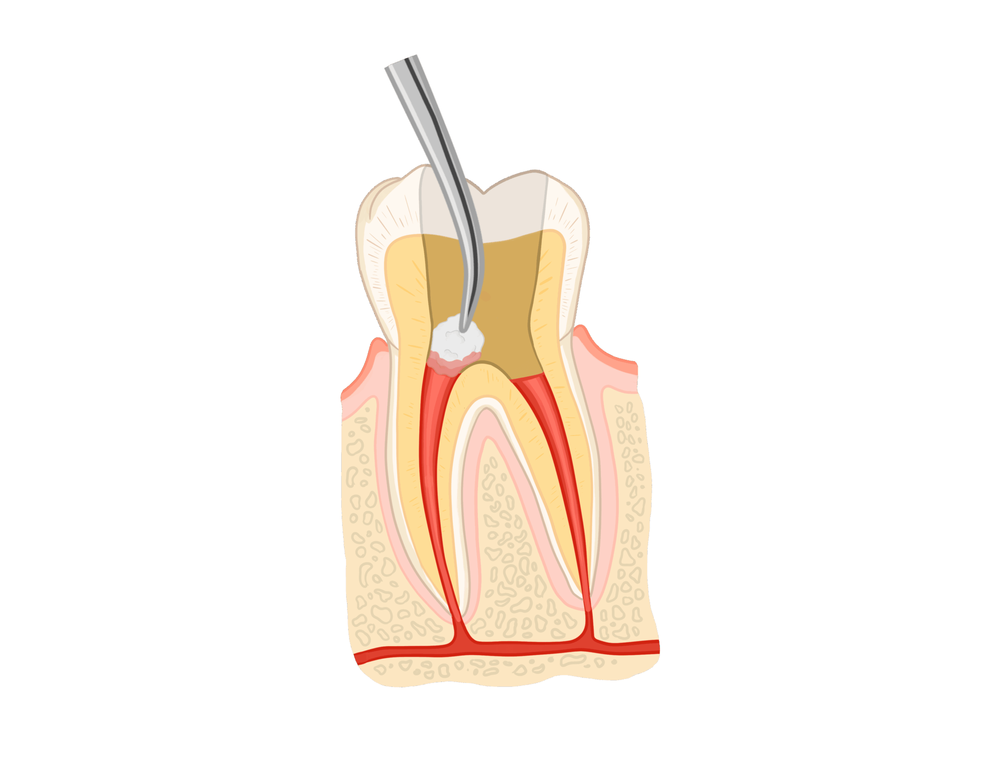 Pulpotomy Vs Pulpectomy My Dental Key