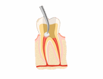 Pulpotomy vs. Pulpectomy - My Dental Key