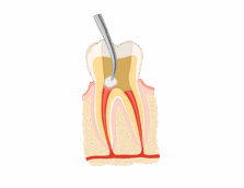 Pulpotomy vs. Pulpectomy - My Dental Key