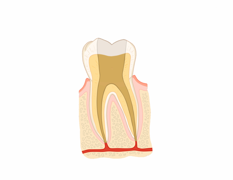 Pulpotomy vs. Pulpectomy - My Dental Key