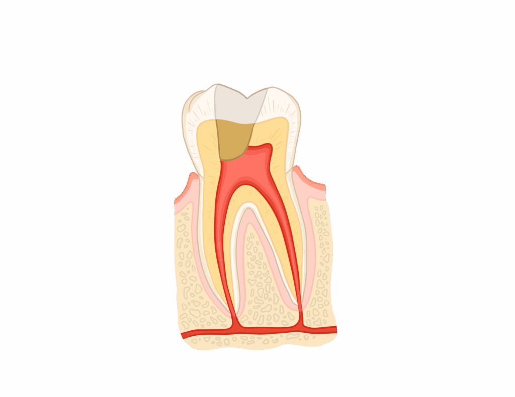 Pulpotomy vs. Pulpectomy - My Dental Key
