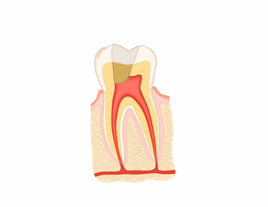 Pulpotomy vs. Pulpectomy - My Dental Key