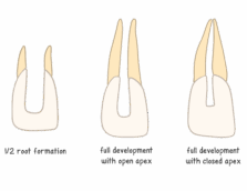 Pulpotomy vs. Pulpectomy - My Dental Key