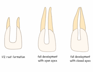 Pulpotomy vs. Pulpectomy - My Dental Key